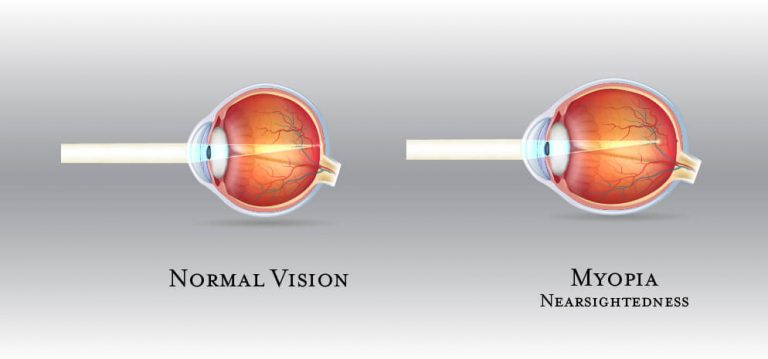 Nearsightedness - Eyecare Optical Knoxville